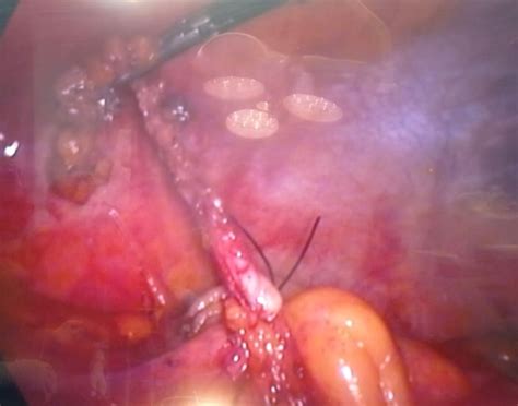 Contemporaneous Presentation Of Acute Appendicitis And Acute