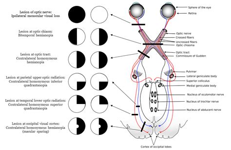 9 Visual Field Defects Ideas Visual Optic Nerve Vision Therapy