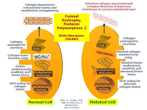 Corneal Dystrophy Posterior Polymorphous 2 Hereditary Ocular Diseases Corneal Dystrophy Posterior Polymorphous 2 Hereditary Ocular Diseases