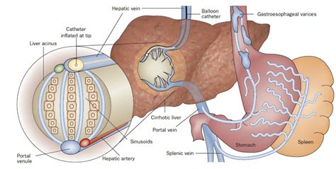 A Puzzling Case Of Portal Hypertension A Collision Between Hema And Hepatology Aasld
