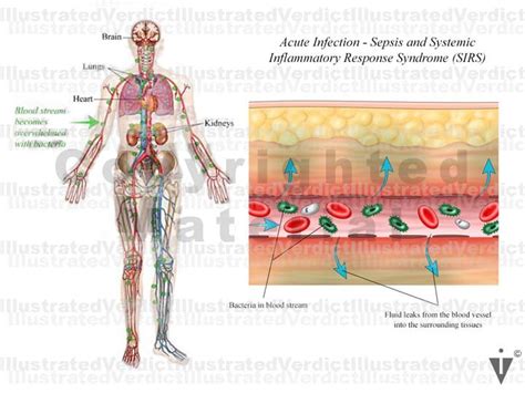 Stock Sepsis Sepsis Overview Illustrated Verdict