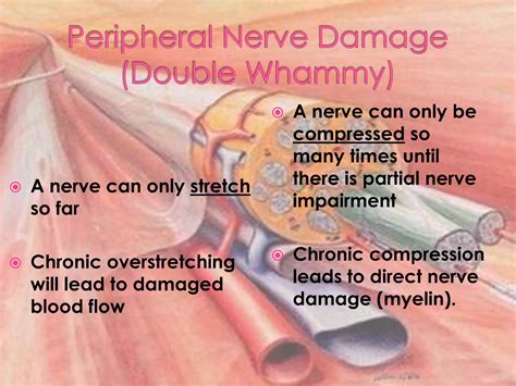 Peripheral Nerve Compression Syndrome Pptx Peripheral Nerve Compression Syndrome Pptx