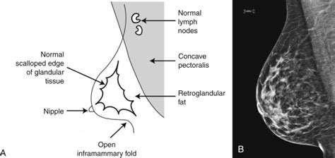 Mammogram Analysis And Interpretation Clinical Tree