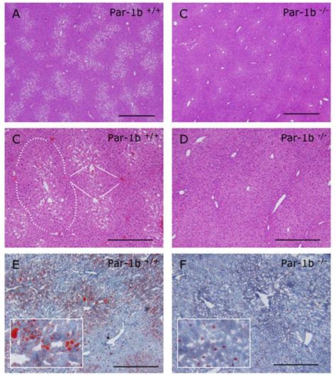 17 Best Images About Hepatic Steatosis On Pinterest A Well Fatty Liver And Metal Pipe
