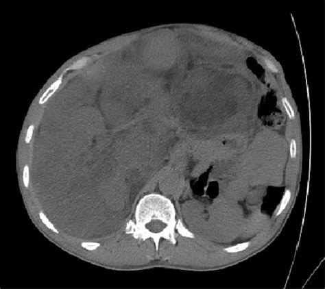 Giant Retroperitoneal Sarcoma A Case Report And Review Of Literature International Journal Of