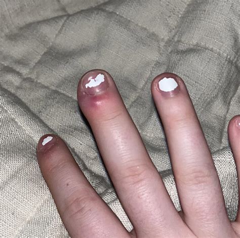 Worst Ingrown Fingernail Say Goodbye To Painful Ingrown Nails With