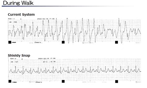 Ecg Noise Reduction Health Science Technologies