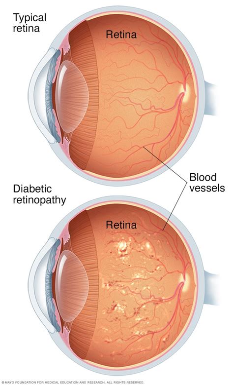 Retinopatia Hipertensiva Vs Retinopatia Diabetica