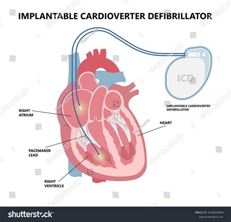 Implanted Defibrillator Over 144 Royalty Free Licensable Stock