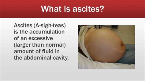 Ascitic Tap Or Paracentesis