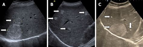 Cavernous Hemangioma Liver Ultrasound