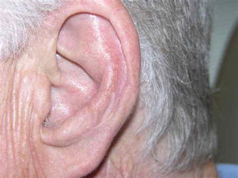 Mohs Micrographic Surgery Arizona Dermatology Specialists Surprise