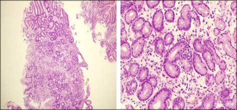 Stomach This Autoimmune Atrophic Pangastritis A Rare Type Of Gastritis Pmc