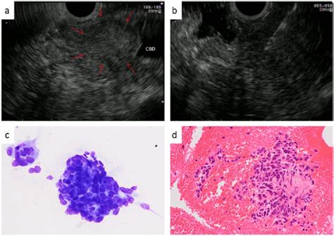 Endoscopic Ultrasound Eus Guided Fine Needle Aspiration Fna For The