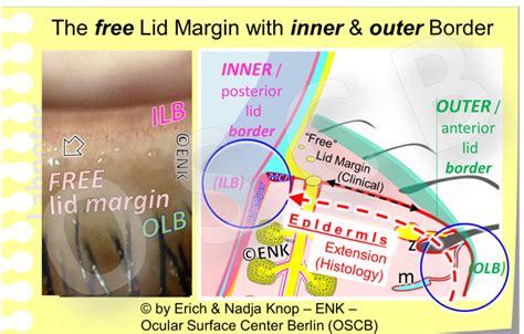 Overview On The Lid Margin — Ocular Surface Center Berlin
