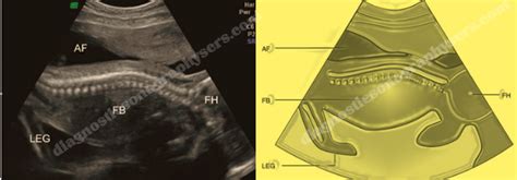 Diagnostic Sonography Scrs Judgment Of Fetal Lie And Fetal Position