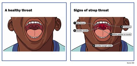 Local Increase In Strep Throat Illnesses Health