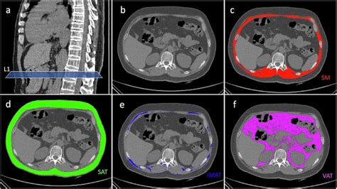Key Chest Ct Parameters For Body Composition May Be Prognostic For Patients With Resectable Nsclc