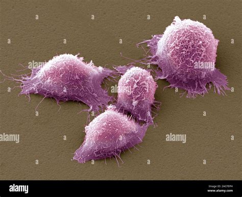 Cervical Cancer Cells Coloured Scanning Electron Micrograph Sem Cultured Cervical Cancer