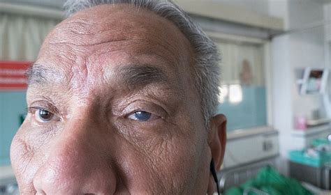 Keratopathy Bullous Condition In Eye Of Elderly Patient Before