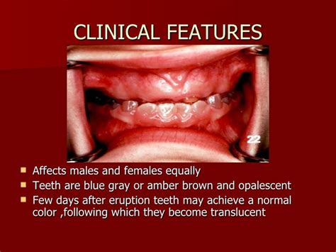 Dentinogenesis Imperfecta