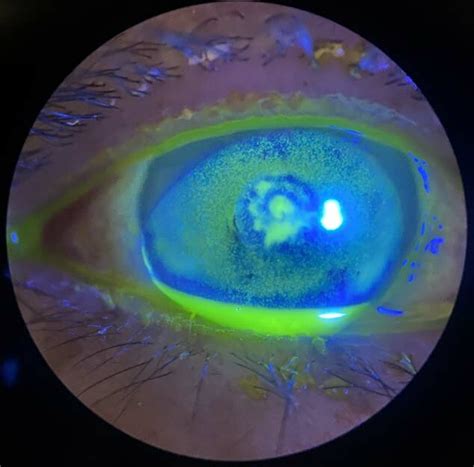 Ophthalmic Examination After Admission Corneal Fluorescein Sodium Download Scientific Diagram