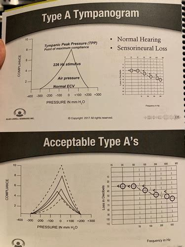 Tympanometry Testing Flashcards Quizlet