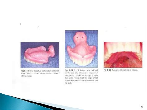Acquired Maxillary Defects Copy Removeable Ppt