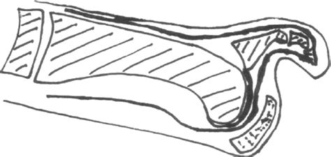 Figure 1 From Use Of The Modified Stainsby Procedure In Correcting Severe Claw Toe Deformity In