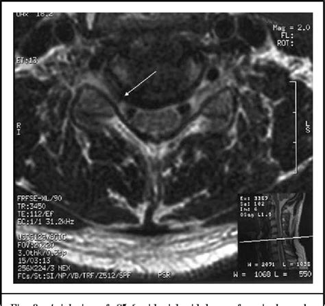 Figure 8 From Mri Images At A 45 Degree Angle Through The Cervical