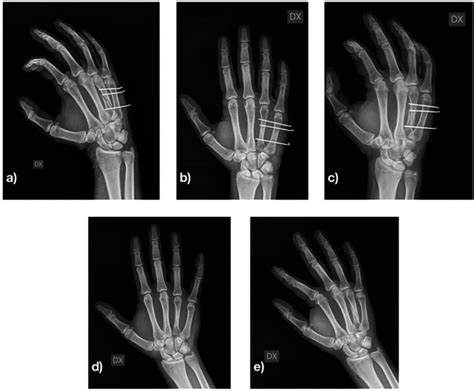Percutaneous Transverse Pinning For Metacarpal Fractures A Clinical Trial Pmc