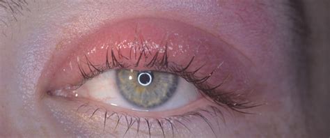 التهاب جفن العين حالة مزعجة جدًا ويب طب