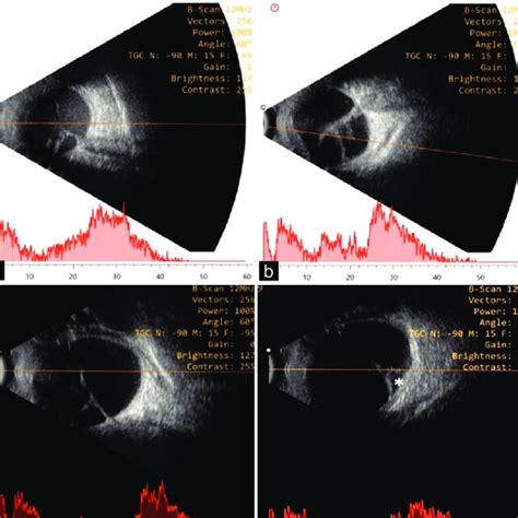 Ultrasound B Scan Of Patient 4 A And B Right Eye And Left Eye