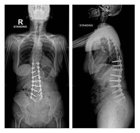 Degenerative Lumbar Scoliosis Surgery In India A Successful Treatment