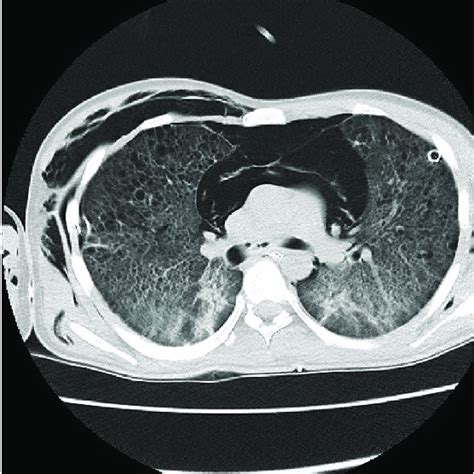 A Ct Scan After 46 Days On Ecmo Both Lungs Have Expanded With
