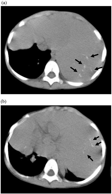 Figure 1 From Massive True Thymic Hyperplasia With Osseous Metaplasia
