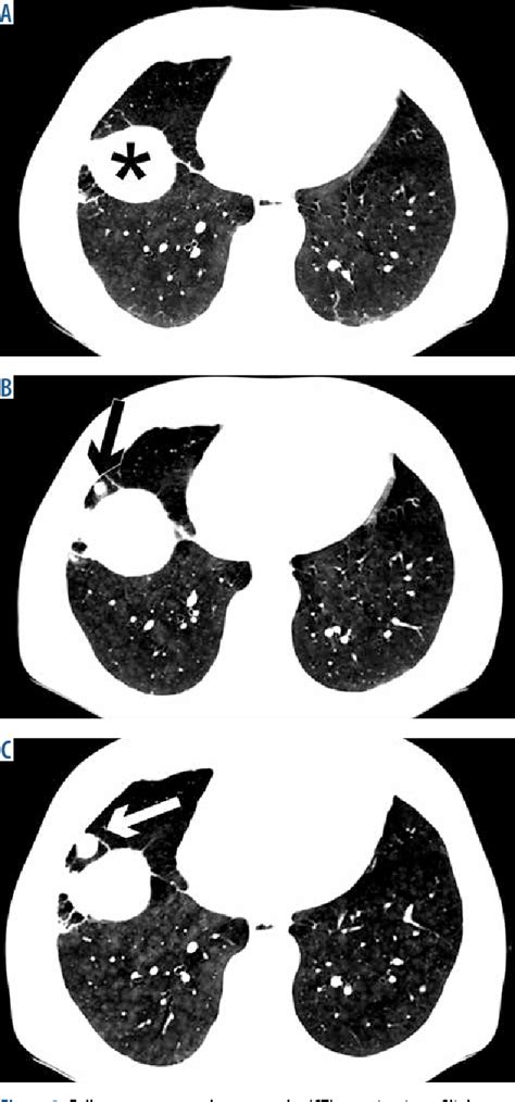 Figure 1 From Metastatic Pulmonary Calcification As A Rare Complication Of End Stage Renal