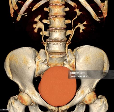 Duplicated Collecting System And One Distal Ureter On The Left 3d Computer Tomography