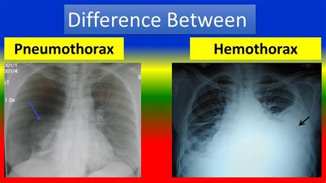 Hemopneumothorax X Ray