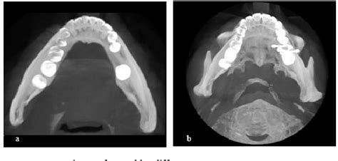 Table 1 From Mandibular Canal Segmentation From Cbct Image Using 3d Convolutional Neural Network