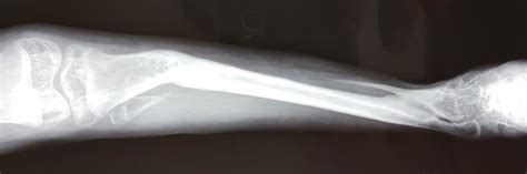 Radiographs Of The Limb Following Tibialization Of The Fibula At Final Download Scientific