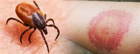 Лаймска болест симптоми причини и лечение