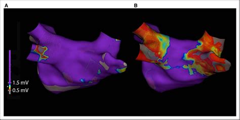 Figure 1 From Pulmonary Vein Isolation With Single Pulse Irreversible Electroporation Semantic