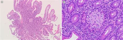 Histologically Confirmed Upper Gastrointestinal Crohns Disease Is It