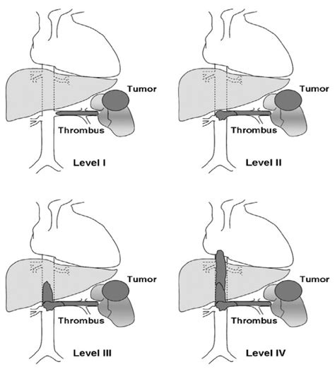 The Mayo Classification Of Macroscopic Venous Invasion In Renal Cell Download Scientific