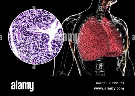 Rotating Animation Of A Smoker S Lungs With Magnified View Of The Affected Tissue Exposure To
