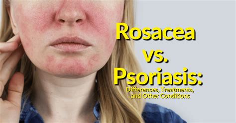 Psoriasis Vs Rosacea Differences Treatment And Other Conditions