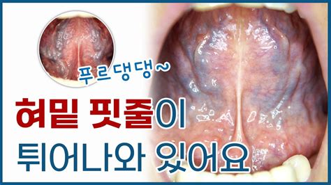 설하정맥 울혈 혀밑 파란 핏줄이 툭 튀어나와 있어요 Youtube
