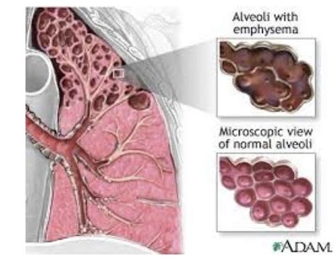 Pulm Copd Ventilation Disorders 45 Flashcards Quizlet