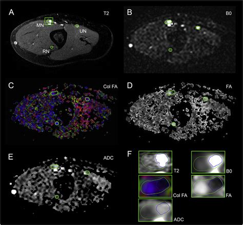 Imaging Analysis Of Dti Parameters Of Median Nerve Lesion And